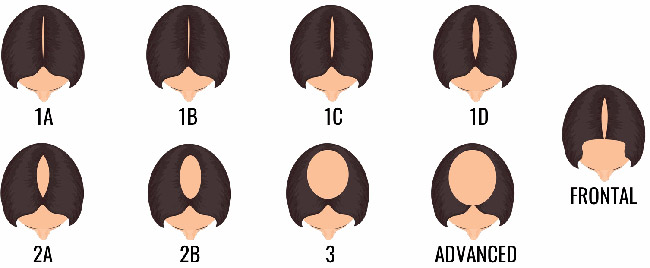Hair Loss in Women - Thinning Hair & Female Hair Loss